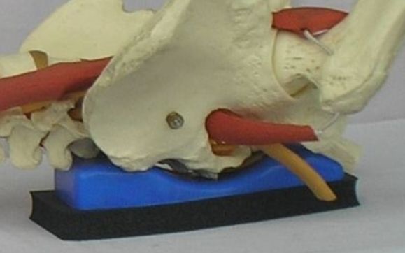 Sacro Wedgy® - Sciatica, low back pain relief by Sacro Wedgy in Mobile ...