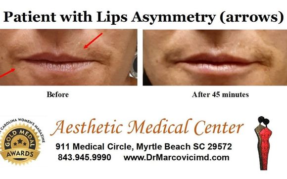 Lips line restauration with Dermal Filler. by AESTHETIC MEDICAL CENTER ...