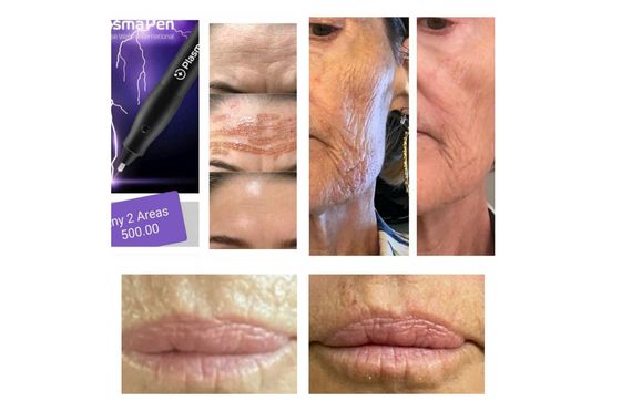 Plasma pen fibroblasting by Renee Lynn Esthetics in Los Angeles, CA ...