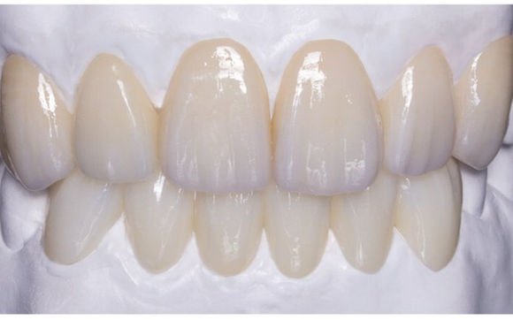 In office custom stain services. by Dreamworks Dental Laboratories in ...