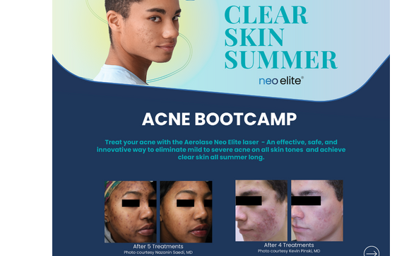 Clear Skin Summer Acne Bootcamp is Here by SkinMD Seattle Laser and Aesthetic Medical Clinic in ...