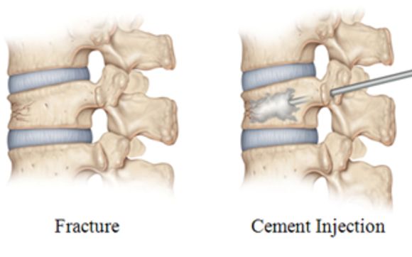 Kyphoplasty for treating Vertebral Compression Fractures by Medical ...