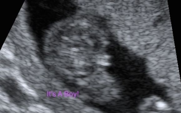 2D Gender determination by Little Wonders 3d 4d Ultrasounds in Normal ...