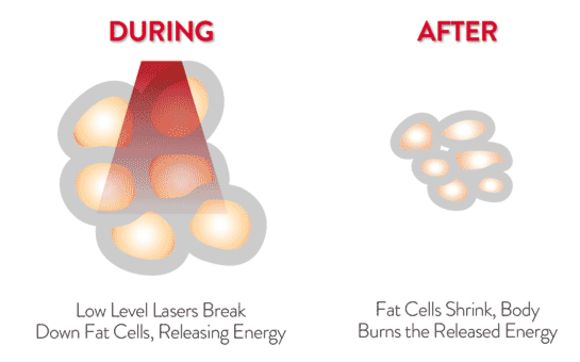 Laser Hair Removal by LightRx Face & Body in Frisco, TX - Alignable