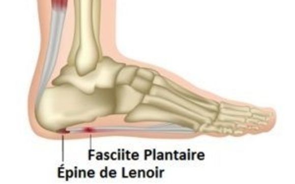 Fasciite Plantaire - Plantar Fasciitis by Clinique podiatrique ...