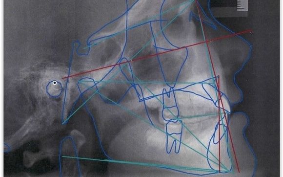 Cephalometric X-Ray Tracing by JRN Dental Lab, LLC in Terre Haute, IN ...