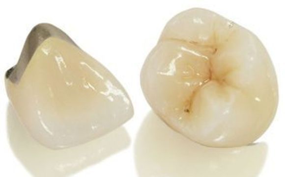 Sunflex Partials by Sun Dental Labs in Pinellas Park, FL - Alignable