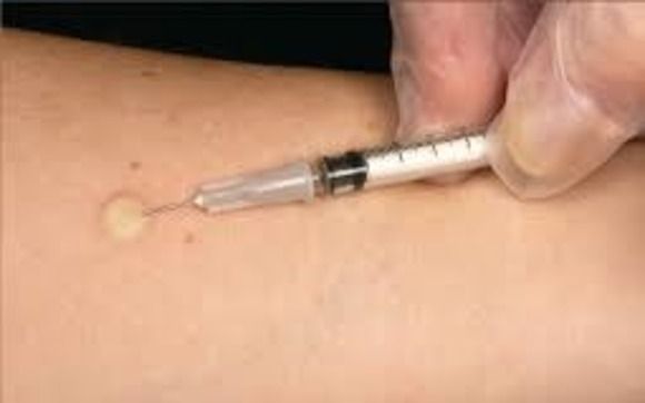 PPD Tuberculosis Skin Test by Landmark Occupational Health in ...