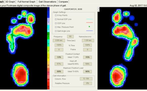 Footmaxx Custom Orthotic system by Fyzical Therapy & Balance Center in Lexington, SC - Alignable
