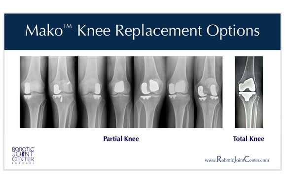 Partial & Total Knee Replacement: Frederick F. Buechel, Jr. MD: Stryker ...