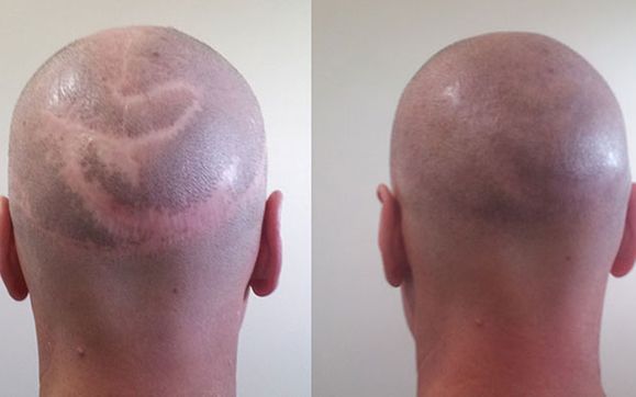 Scalp Micropigmentation for Scars by New Level Aesthetics in Charlotte ...