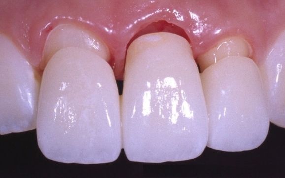 Dental Bridge by Promont Dental Design Emergency, Implants, Family ...