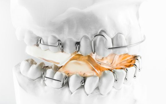 Bionator by Gaudi orthodontics inc in Calgary, AB - Alignable