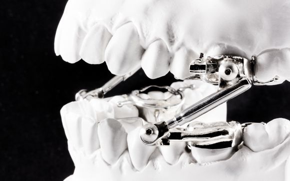 Hygiene lingual wire retainer by Gaudi orthodontics inc in Calgary, AB ...