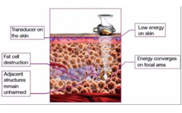 ULTRASOUND CAVITATION by Advanced Body Sculpting USA in San Antonio, TX ...