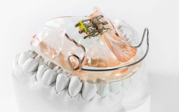 Bionator by Gaudi orthodontics inc in Calgary, AB - Alignable