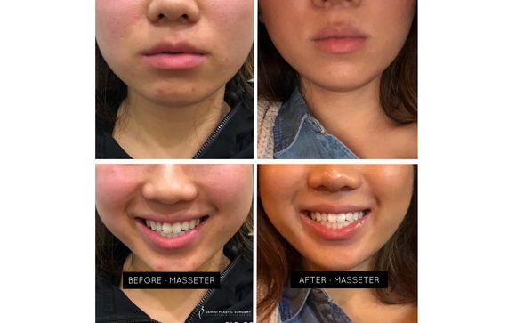 Client TeeVee receives masseter reduction with Botox by Gemini Plastic ...