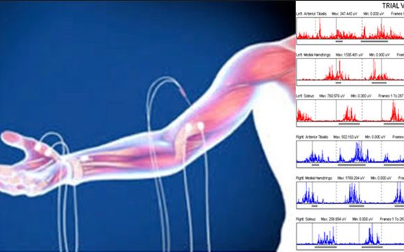 EMGs- Diagnostic Electromyograph & Nerve Conduction Study by Rehab ...