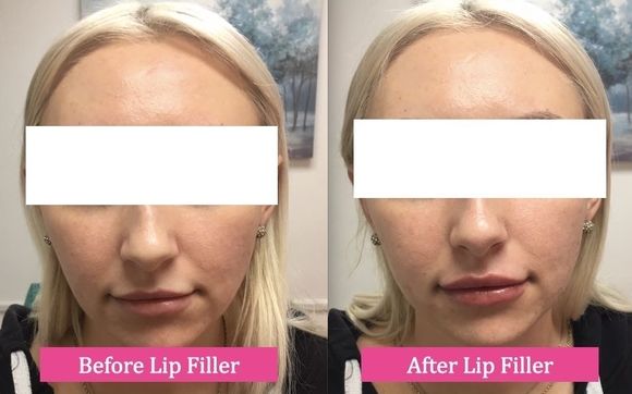 Botox 20 units x $115 / Restylane dermal fillers full syringe x $300 ...