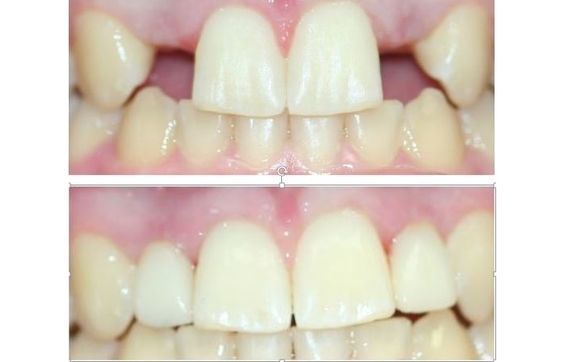 Natural looking restoration - Cosmetic Restorations by Robert A. Lantzy ...
