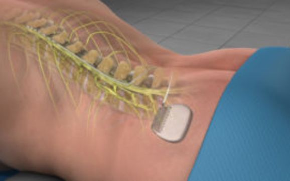 Dorsal Column Stimulator Trials by Synergy Rehabilitation and Wellness ...