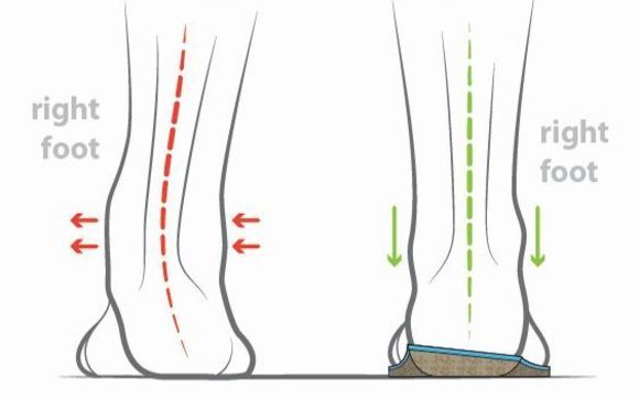 Custom Molded Orthotics by Michael L Ashley C. Ped in Dallas, TX ...