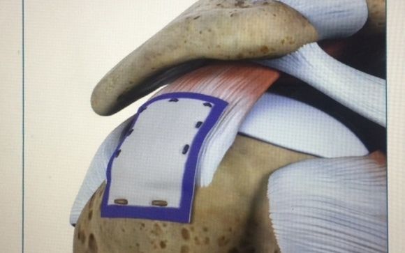 Rotator Cuff Repair with Collagen Patch by Advantage Orthopedics, Inc ...