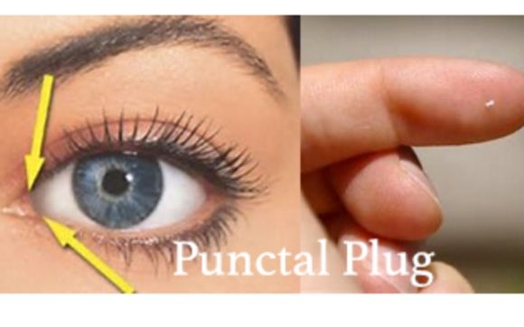 Punctal Plugs by Sunrise Specialty Lens & Dry Eye Institute in Sunrise ...
