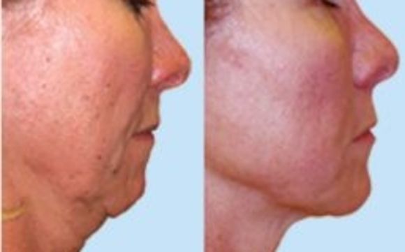 Non-surgical face and neck lift by Dermacare Non-Surgical Face & Body ...