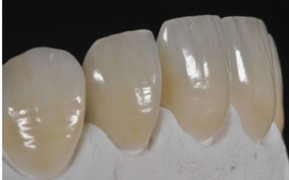 Feldspathic Veneers by GIE Dental Lab in Glendale, CA - Alignable