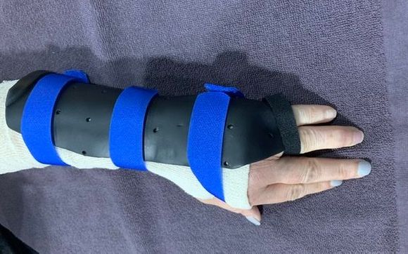 Custom Splinting by Ascend Hand Therapy in The Colony, TX - Alignable