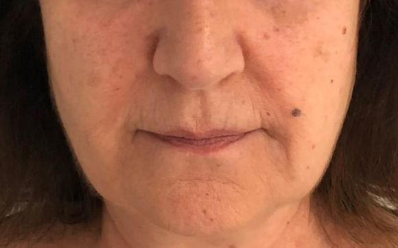 Lunchtime face lift by SkinMed in New York, NY - Alignable