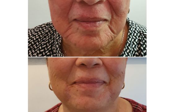 Biofiller with thread lift combination by SkinMed in New York, NY ...