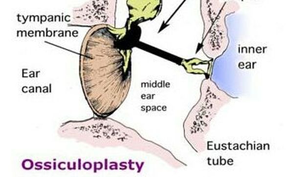 Repairing ear bones by Mitchell Austin MD FACS in Tampa, FL - Alignable