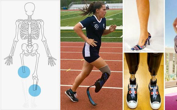 Van Nes Rotationplasty by A Step Ahead Prosthetics in Hicksville, NY ...