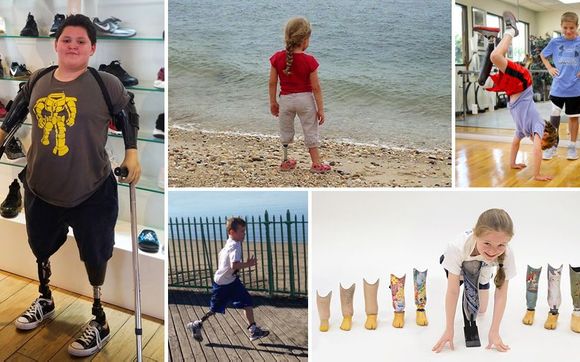 Pediatric Prosthetics by A Step Ahead Prosthetics in Hicksville, NY ...