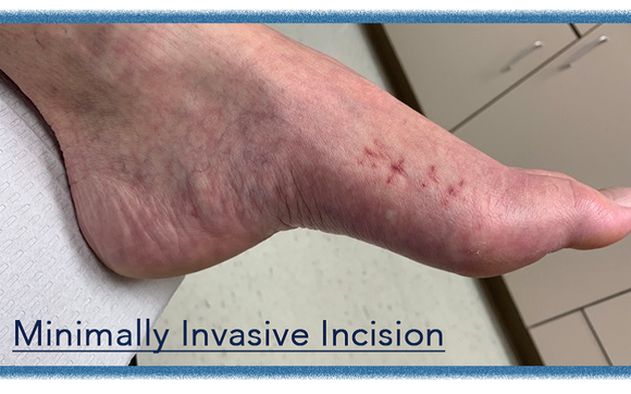 Minimally-invasive surgeries by Great Lakes Foot and Ankle Institute in ...