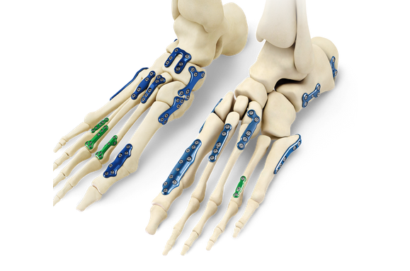 ARSENAL Foot Plating System by Trilliant Surgical Authorized ...