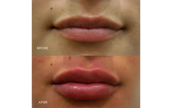 Lip Goals, Lip Fillers · Gemini Plastic Surgery · Rancho Cucamonga by ...