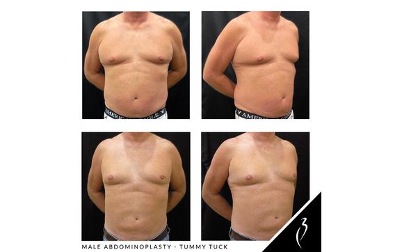 Male Tummy Tuck Procedure · Rancho Cucamonga · Della Bennett, MD ...