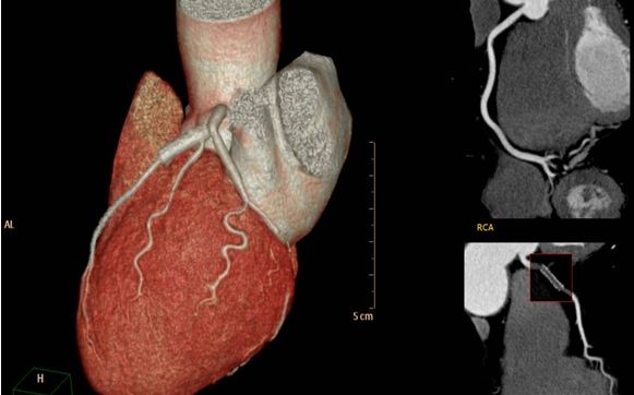 CT Heart/Coronary Artery/Calcium scoring by ALFA DIAGNOSTIC in Aventura ...