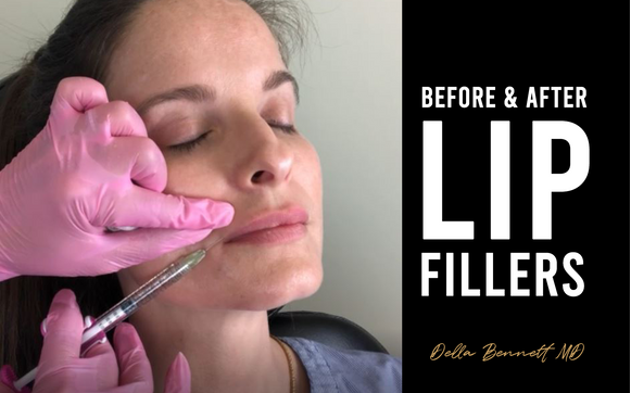 Vermilion Border Procedure · Rancho Cucamonga, Chino Hills, Inland ...