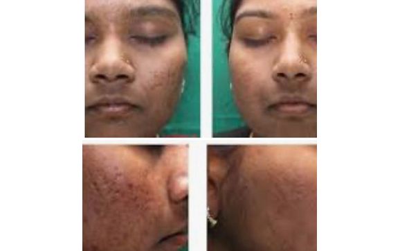 Infini, Microneedling with Radio Frequency by California Sun Spa in ...