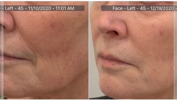 Botox, dermal fillers, fat dissolving injections and Platelet Rich ...