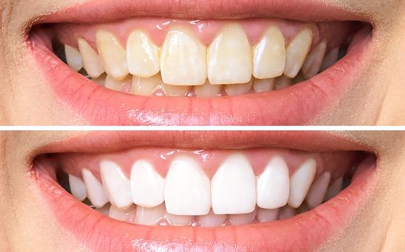Sparkle LED Teeth Whitening Package by Sparkle White Smiles in ...