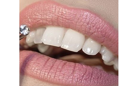 Tooth Gem and Application by Sparkle White Smiles in Abbotsford, BC ...