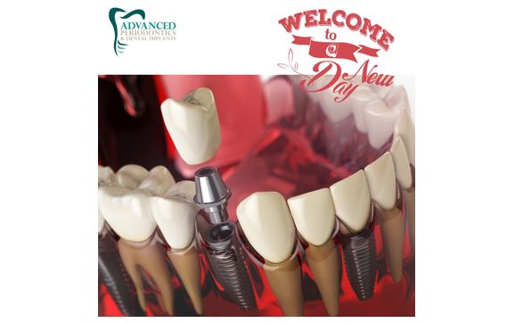 Dental implants for new beautiful and functioning smile! by Advanced ...