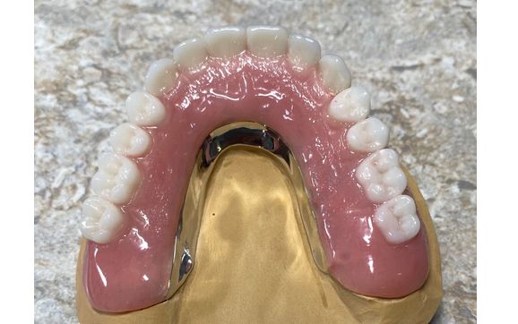 Implant supported locator over denture. by Shelter Cove Dental Studio ...