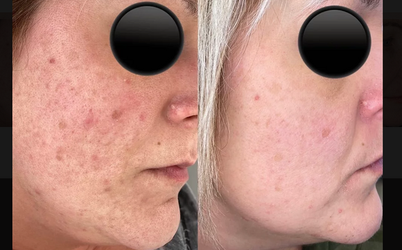 Acne Bootcamp by Glow Envy Med Spa in Midlothian, VA - Alignable