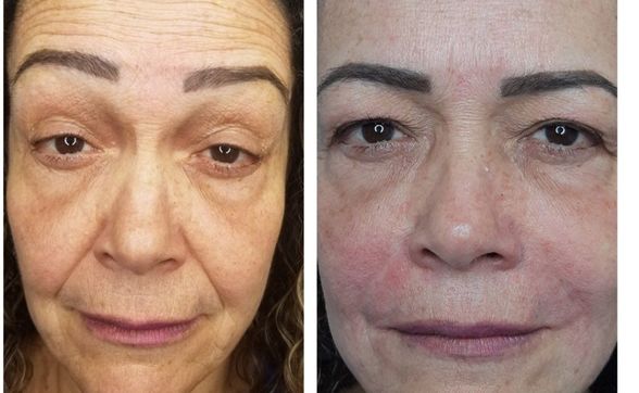 Botox, Filler, PRP, peeling, micro-needling, micro dermal-abrasion. by ...